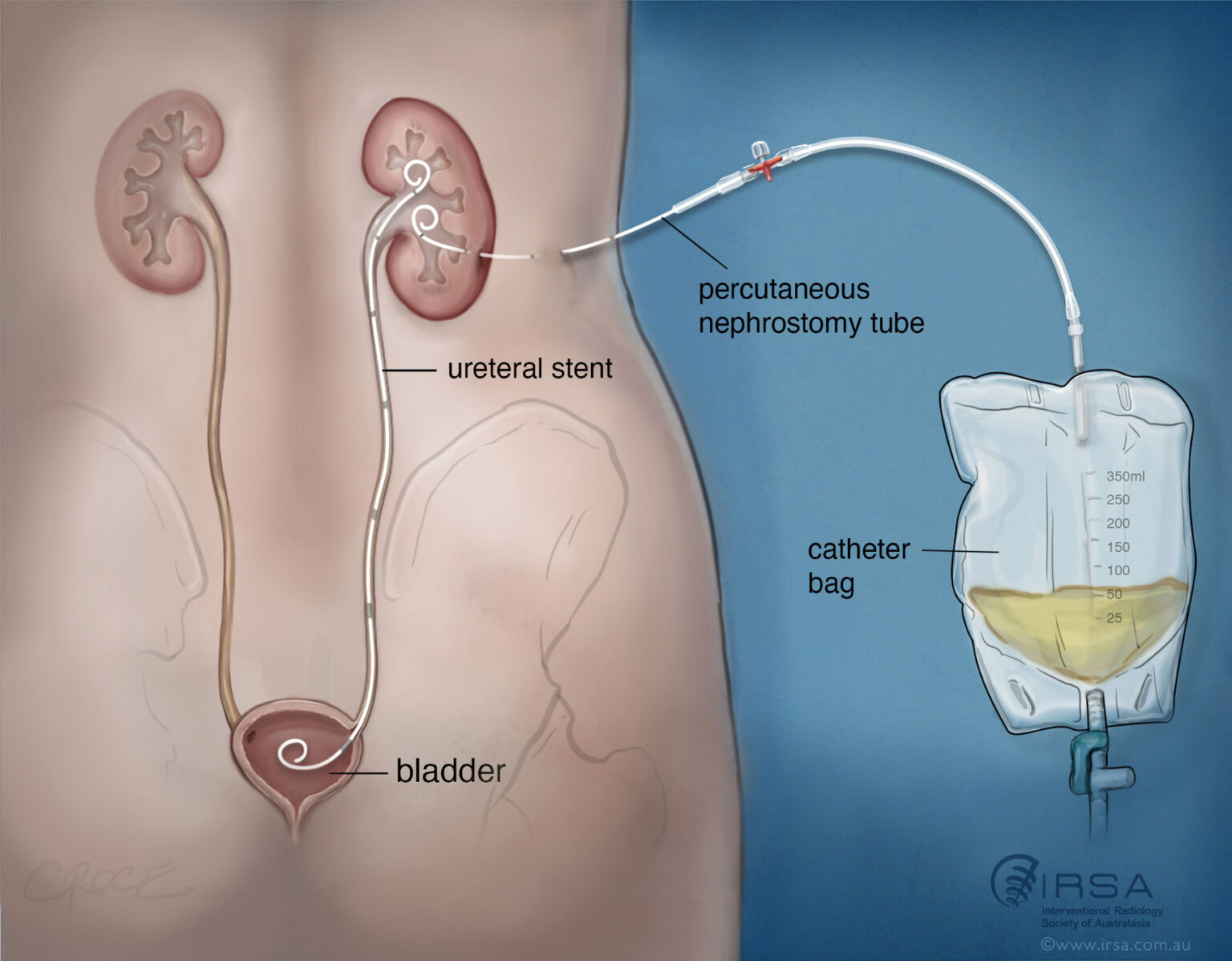 Nephrostomy Interventional Radiology Procedure For Kidney Care Nephrostomy Interventional Radiology Procedure For Kidney Care